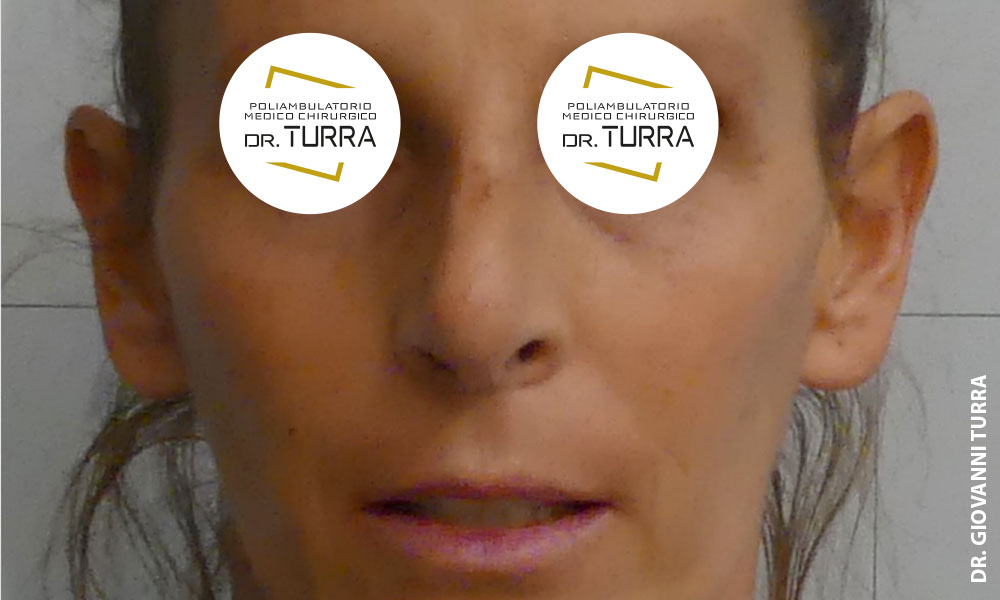 Rinoplastica - english - Dr. Giovanni Turra